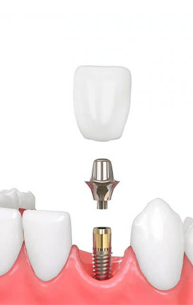 Prices for Dental Work in Mexico - Patients Treatments Guide
