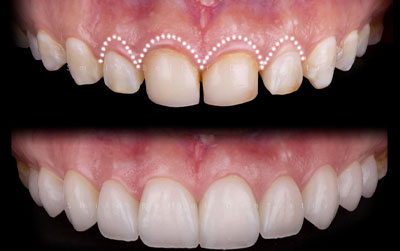 Composite Veneers in Mexico: How much are, Materials, Cases, Reviews