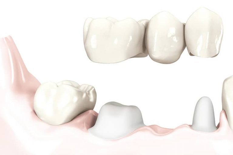 How much does a 3 Unit bridge cost in Mexico? - Update Prices 2024